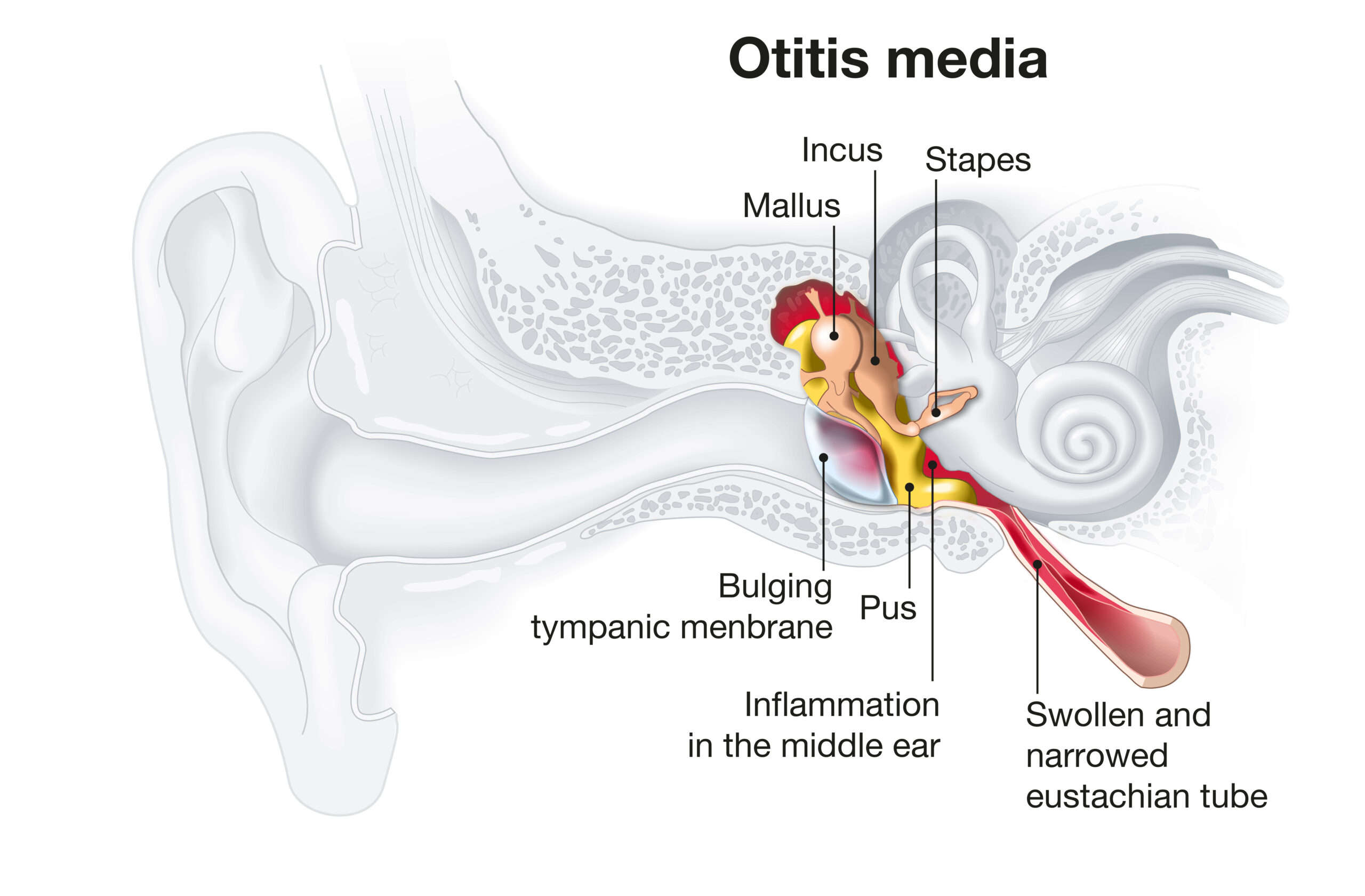 Inflammation of the middle ear, otitis media, medically illustration ...