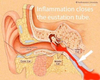 eustachian dysfunction - US Version | Sound Therapy